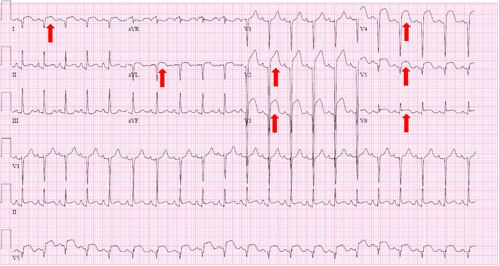 Aortic Thrombosis and Subsequent Myocardial Infarction in a Previously ...